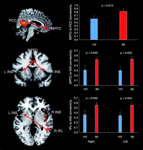 Resting State Connectivity Between Default Mode Network And Insula