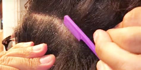 dandruff scraping videos are the new pimple popping videos self