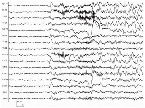 Principles And Techniques For Long Term Eeg Recording Emu Icu