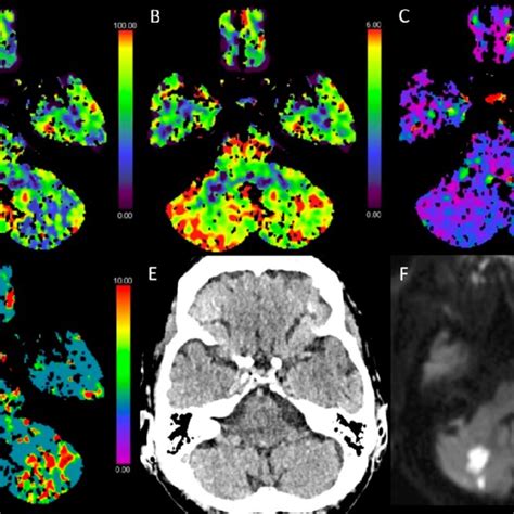 Color Coded Maps Generated From Computed Tomography Perfusion Ctp Of