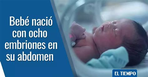 El Insólito Caso De Una Bebé Que Nació Con Ocho Embriones En Su Abdomen
