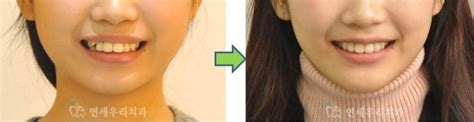 치아 발치 교정 후 돌출입 개선 교정치과 전후 사진 비교 A2