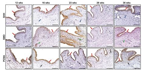 Figure 1 From Spatiotemporal Expression Of Shh Gli Signaling In Human