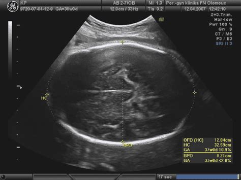 [pdf] Discrepancy In Ultrasound Biometric Parameters Of The Head Hc
