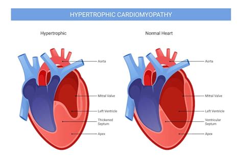 Premium Vector Hypertrophic Cardiomyopathy Infographic Illustration