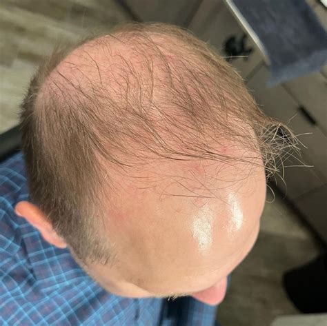 Hairskeen Hair Replacement For Men Columbus Oh Pleij Salon Spa