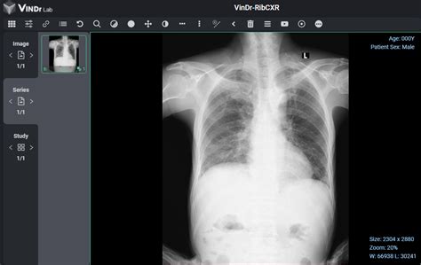 Vindr Ribcxr A Benchmark Dataset For Automatic Segmentation And
