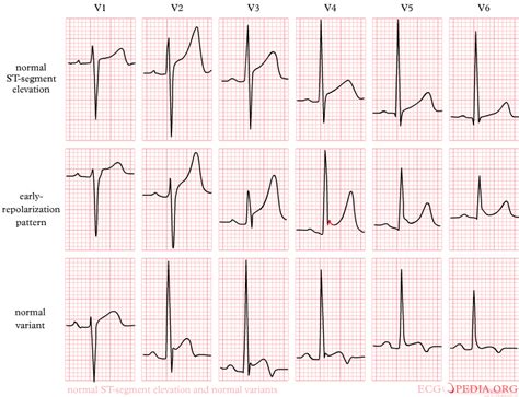 File Normal St Elevation Png Ecgpedia