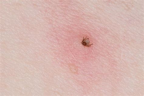 how to get rid of ticks