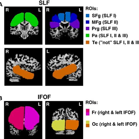 Hemispheric Lateralization Of The Frontoparietal Pathways Mean Hmoa