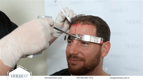 Hermest Hair Transplant Turkey Youtube