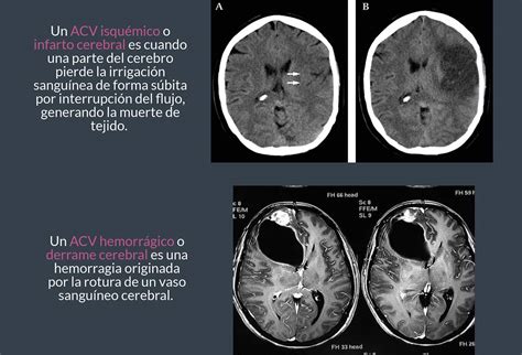 Diferencias Entre Ictus Y Derrame Cerebral Normalweb Es