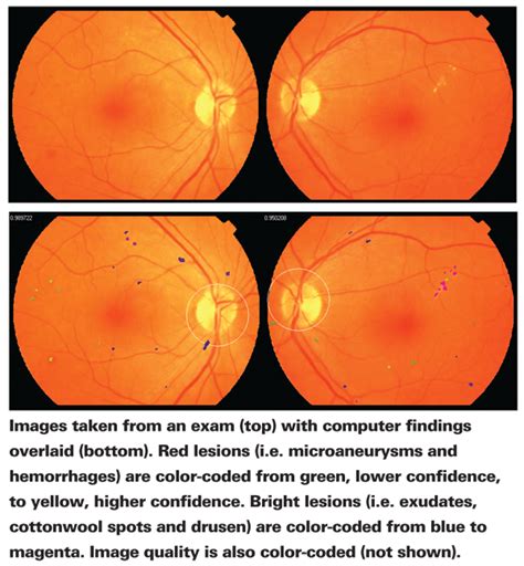 diabetic retinopathy automated detection