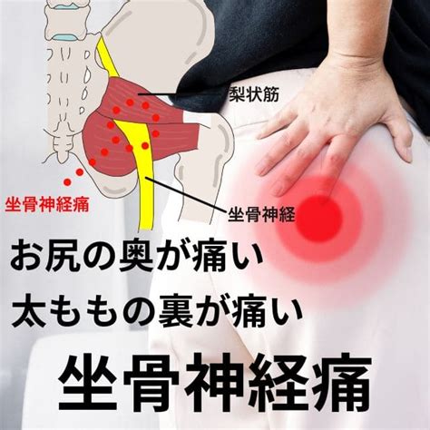 坐骨神経痛で絶対に避けるべきこと 整体のプロが原因と治し方を解説