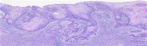 Molecular Analysis Of Hpv Independent Primary Endometrial Sq The