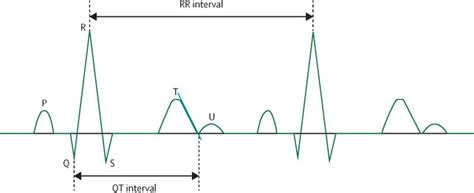 The Qt Interval Prolongation Potential Of Anticancer And Supportive