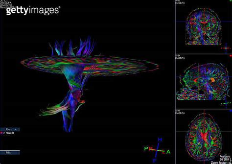 Tractography Dti Diffusion Tensor Imaging Mri Of The Brain 이미지
