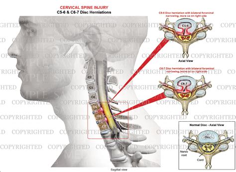 2 Level C5 6 And C6 7 Cervical Disc Herniation Bilateral Foraminal N