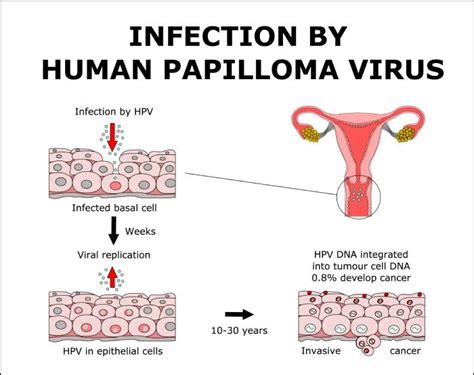 Human Papillomavirus Hpv Causes Symptoms And Diagnosis