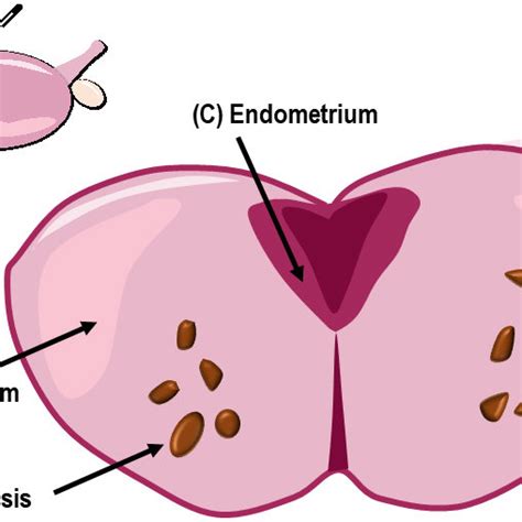 A Schematic Depiction Of The Uterine Tissue Sampling During Surgery