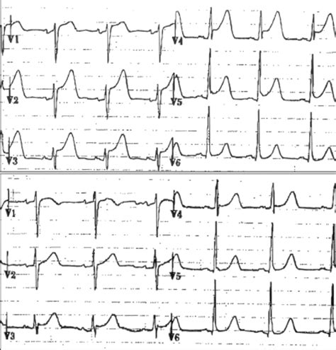 Applying The New Stemi Guidelines 1 Reperfusion In Acute St Segment