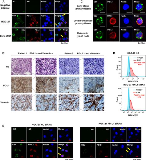 Costaining Of Pd‐l1 And Csv In Gc Cell Lines And Tumor Tissue A