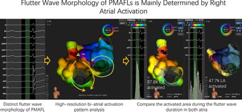 Flutter Wave Morphology Of Peri Mitral Atrial Flutters Is Mainly