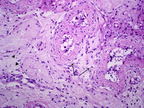 Testicular Biopsy Of A Patient Showing Seminiferous Tubules With