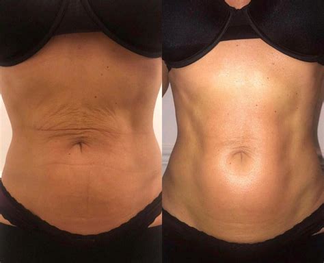 Radio Frequency Skin Tightening Atlantis Aesthetics