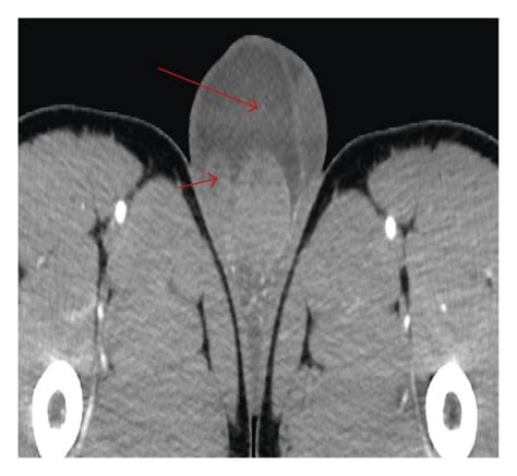 Axial Computed Tomography Ct Image Depicting A Heterogeneous Right