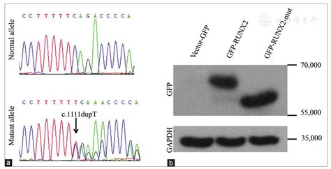 Novel Mutation Of Cleidocranial Dysplasia Related Frameshift Runt