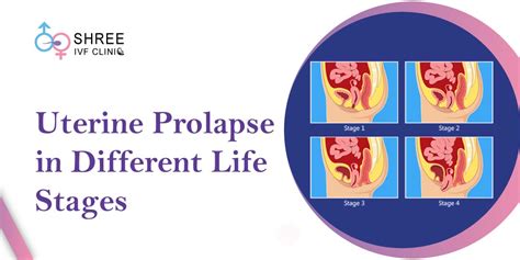 Uterine Prolapse How It Affects Women At Different Life Stages