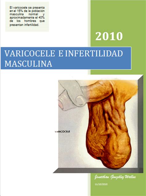 Caso ClÍnico UniquindÍo Varicocele E Infertilidad Masculina