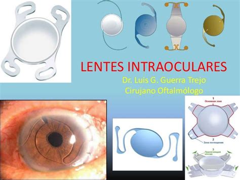 Lentes Intraoculares