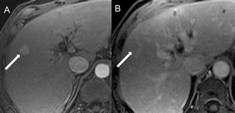 Example Of An Intrahepatic Cholangiocarcinoma Icca With A