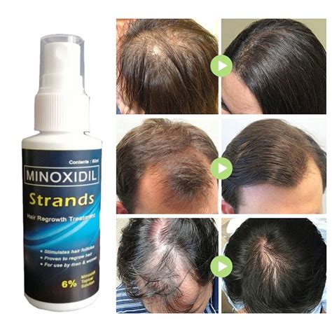 Minoxidil Strands 6 Minoxidil Topical Solution 60ml Per Bottle Hair