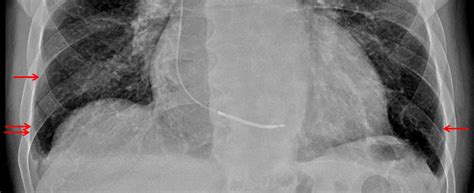 chest radiograph case 11