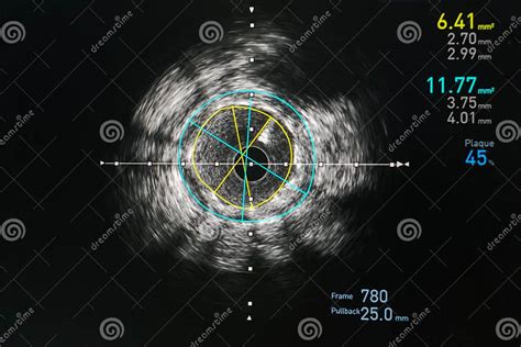 Intravascular Ultrasound Imaging Ivus Stock Image Image Of