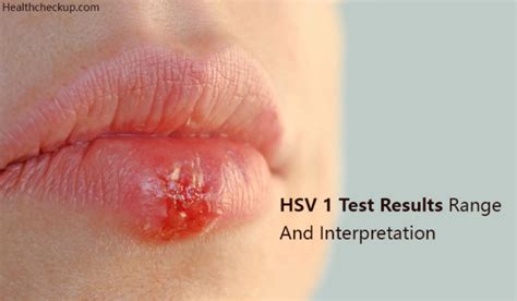 hsv 1 test results range and interpretation health checkup