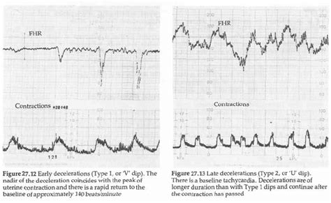 Early And Late Decelerations In Traditional British Practice