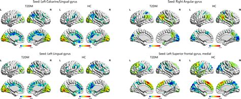 Frontiers Disrupted Balance Of Long And Short Range Functional