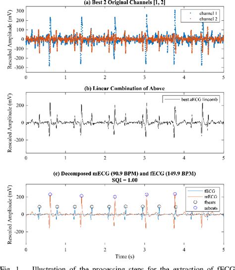 Figure 1 From A Novel Method For The Extraction Of Fetal Ecg Signals
