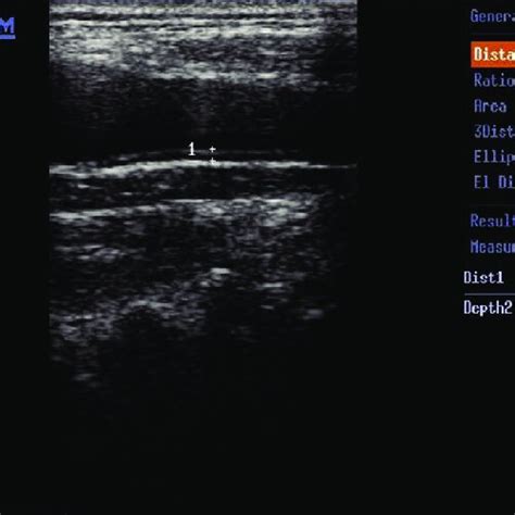 Measurement Technique Of Obtaining Carotid Intima Media Thickness In A