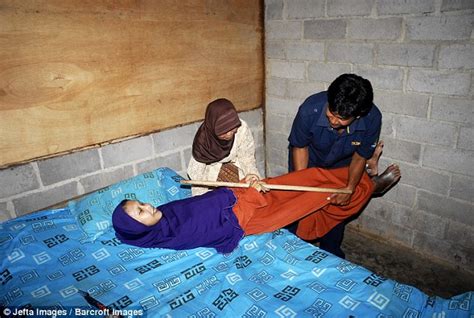 indonesian woman s rigid spine from ankylosing spondylitis