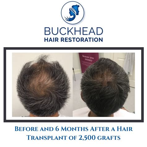 Neograft Overview No Linear Scar Fast Recovery Buckhead Location