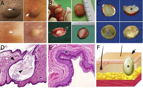 Sebaceous Cyst Vs Lipoma