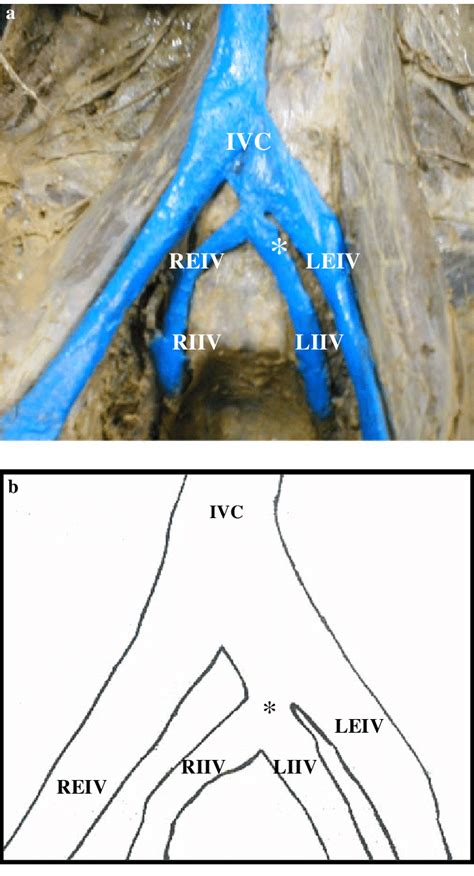Common Iliac Artery And Vein