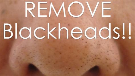 10 Ways On How To Pop Blackheads On Nose Healing Picks