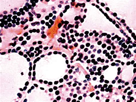 Pathology Outlines C Cell Hyperplasia