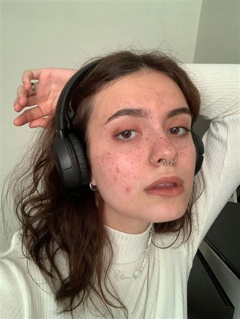 E V I E Girl With Acne Pretty Skin Skin
